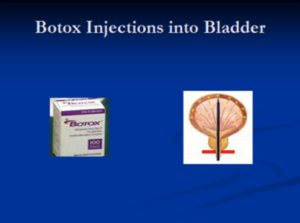 Treatments for Overactive Bladder - Tees Urology